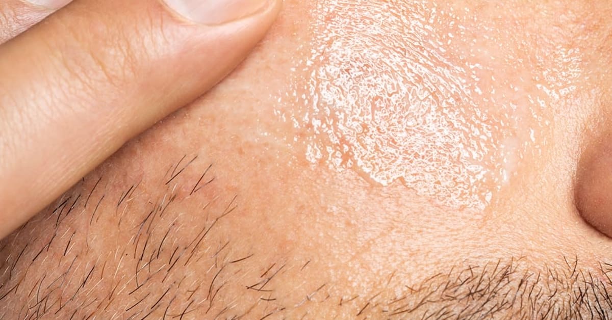 Acne Around The Mouth: Causes, Prevention, and Treatment | hims